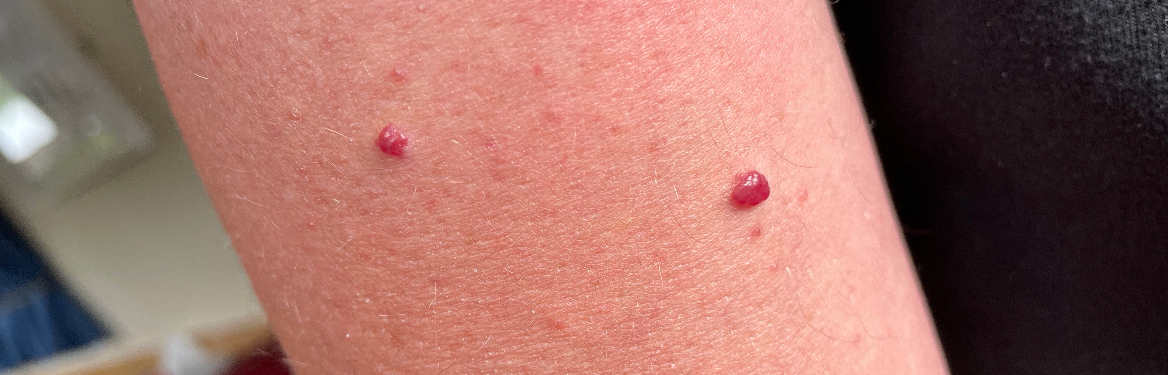Should I get my moles checked? – Pete's Blog